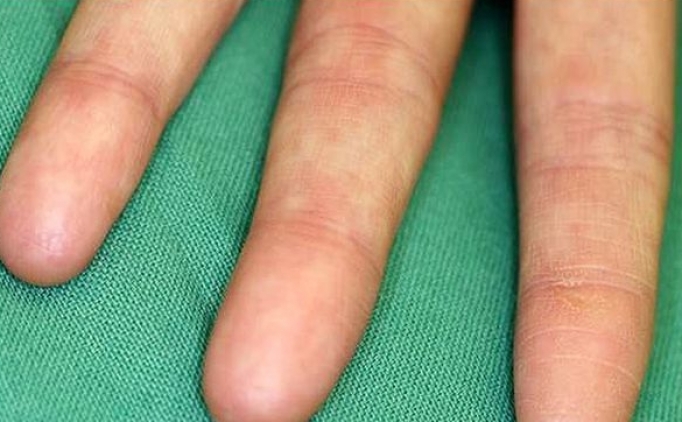 Adermatoglyphia (Adermatoglifiya) nedir? Adermatoglyphia genetik ...